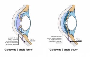 Glaucome : symptômes, causes & traitements - Institut Amelis d